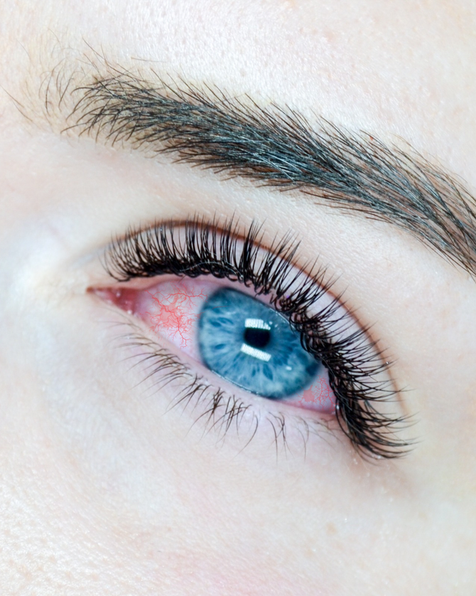 Chemical Burn During Eyelash Extension Application